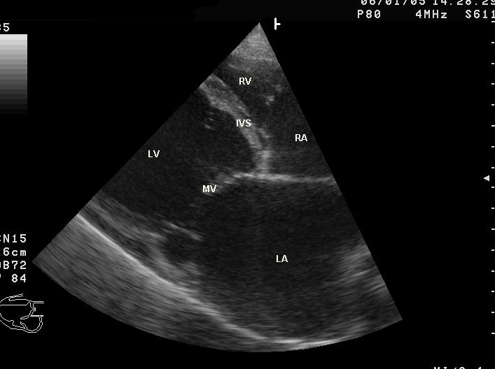 Dilated Cardiomyopathy Medlibes Online Medical Library